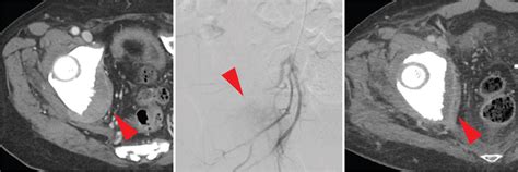 Transarterial Embolization Of Bone Metastasis Using Pedd Left A