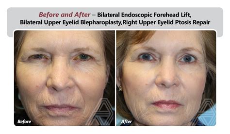 Brow Ptosis Triad Eye Institute