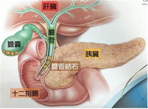結石卡在膽囊管釀腹痛、發燒！免開刀膽管內視鏡搭電擊碎石術，成功解除頑石 華人健康網 專業即時優質的健康新聞及資訊分享平台業即時優質的