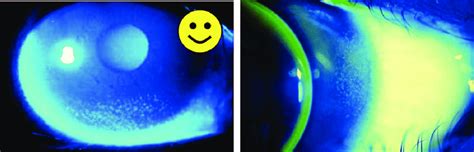 Left Smile Pattern Of Corneal Staining Is Characteristic In Soft