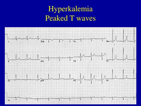 Ppt Electrolyte Abnormalities Powerpoint Presentation Free Download