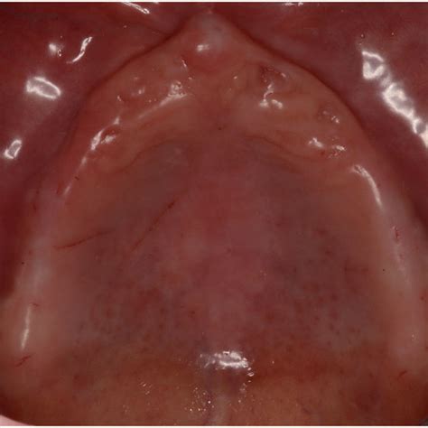 Occlusal View Of The Maxilla Shows An Atrophic Ridge With A Shallow