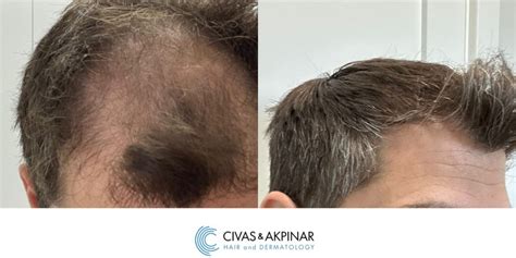 Civasandakpınar Hair Transplant Fue Hair Transplant Before And After