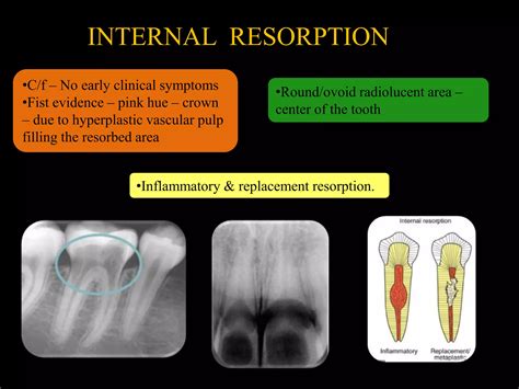 Resorption Of Teeth Pptx