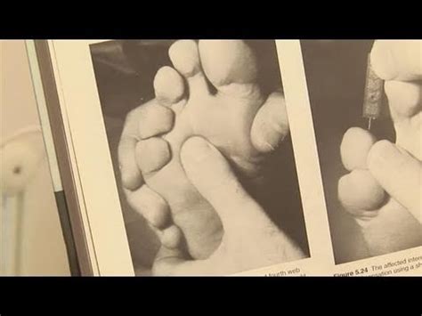How To Treat Mortons Neuroma Youtube