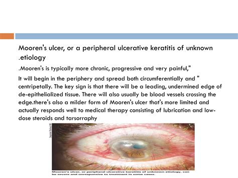 Peripheral Ulcerative Keratitis Puk Pdf