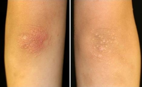 Skin Rash In Elbow Crease Rash 7 Common Skin Rashes Causes And
