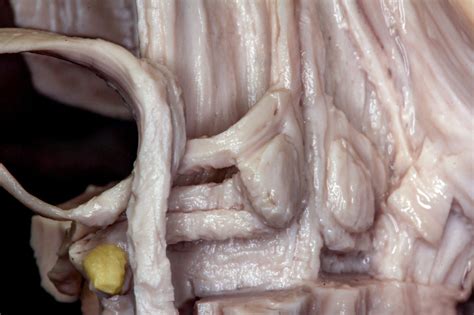 Dissected Brainstem Demonstrating The Abducens Nucleus And Facial Nerve