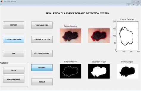 Skin Cancer Detection Using Matlab Image Processing Projects