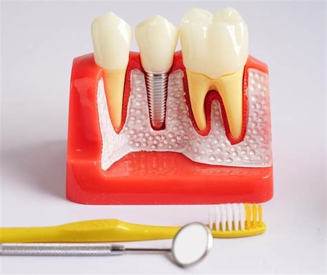 Premium Photo Dental Implant Artificial Tooth Roots Into Jaw Root