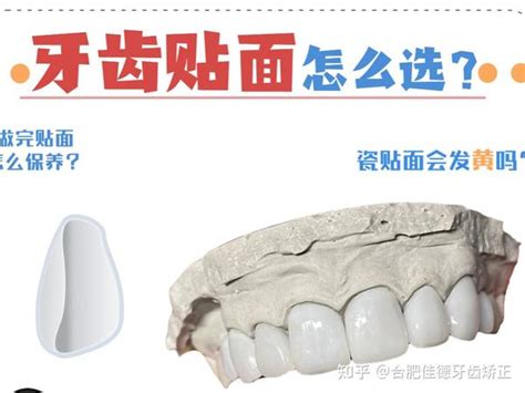合肥瓷贴面去哪好？什么情况需要做牙贴面？有些人不能做瓷贴面？ 知乎