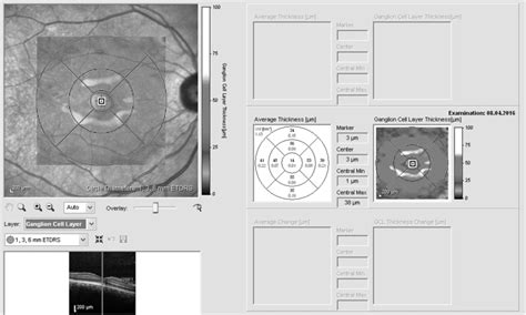 By The Segmentation Application The Thicknesses Of Retinal Nerve Fiber Download Scientific
