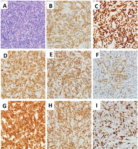 Figure 2 From Hypodiploid B Lymphoblastic Leukemia Presenting As An