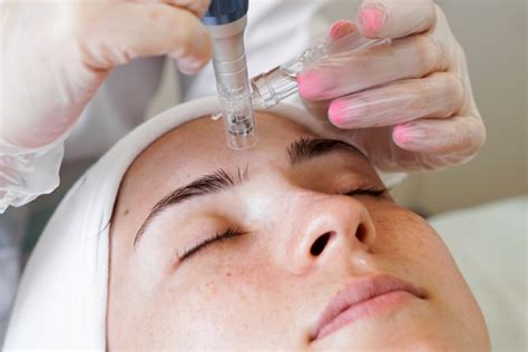 Botox Vs Microneedling Which Offers A Better Beauty Boost