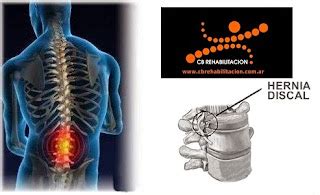 CARLE BARON REHABILITACION COLUMNA HERNIA DISCAL
