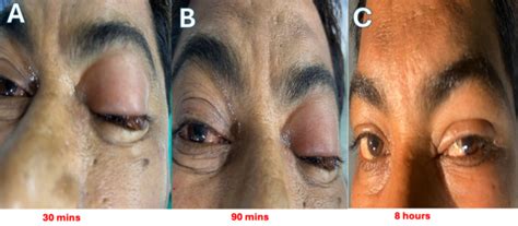 Acute Allergic Blepharoconjunctivitis During Percutaneous Coronary
