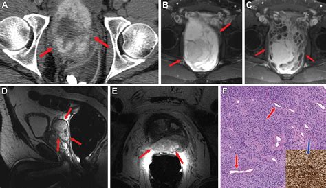 Mesenchymal Neoplasms Of The Prostate And Seminal Vesicles Spectrum Of