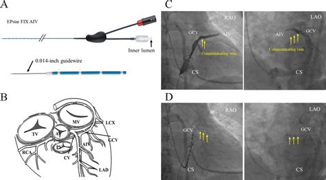A Epstar Fix Aiv Is A 27 Fr Decapolar Electrode Catheter With The