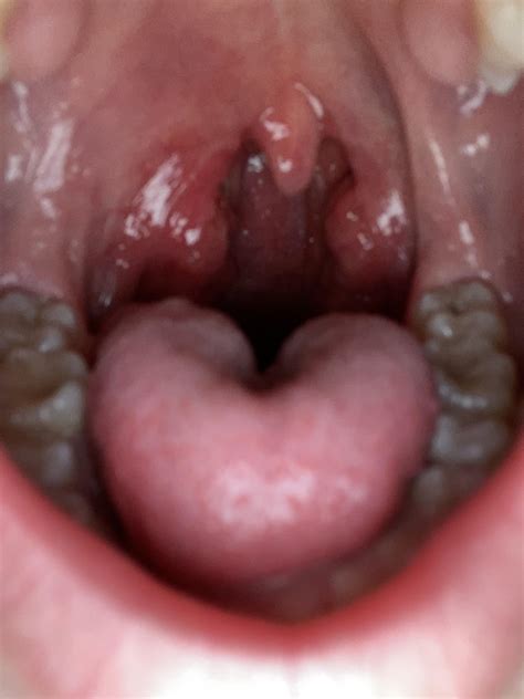 20 Year Old Male Had Oral Sex Again And My Tonsils Got Swollen Again