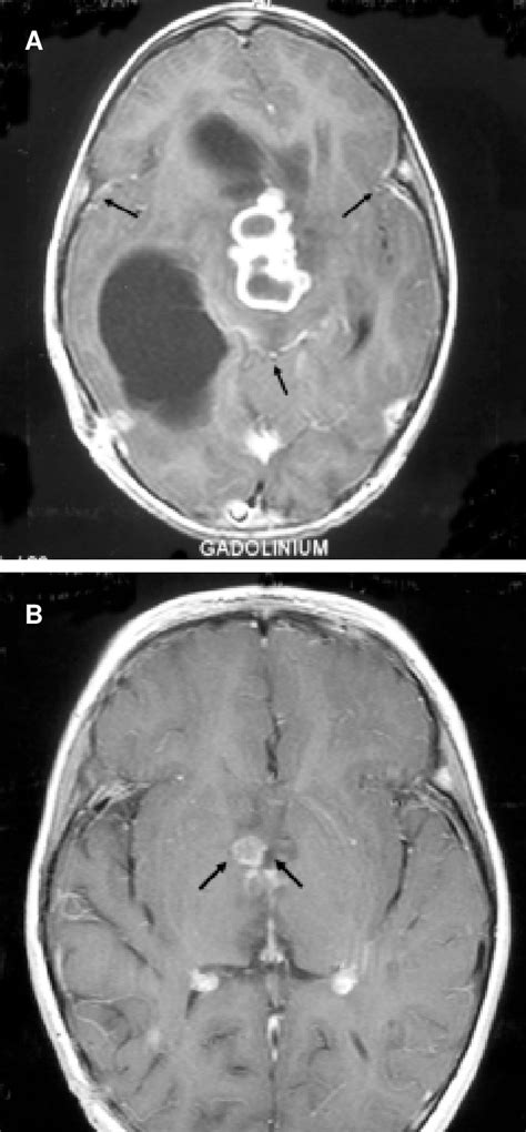 Tuberculous Abscess Semantic Scholar