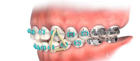 Triangle Elastics R Orthotropics