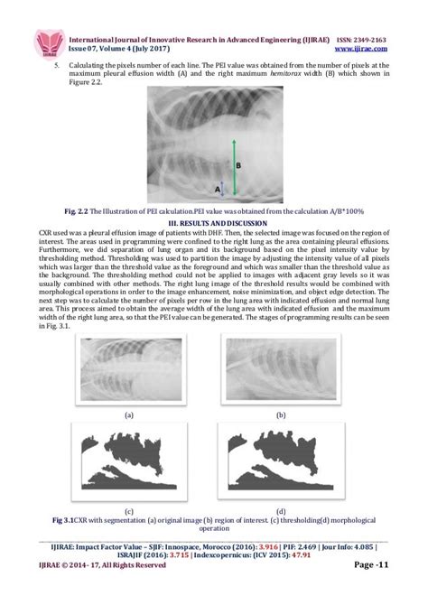 Chest X Ray Segmentation To Calculate Pleural Effusion Index In Patie