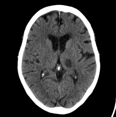 Lacunar Infarct — Neuro Junction