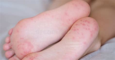 Red Spots On Foot Hot Sale