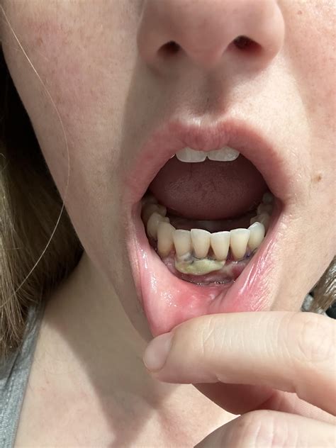 Gum Graft Failing Raskdentists