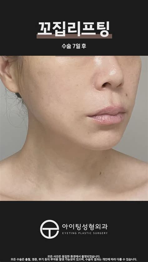 아이팅성형외과ㅣ눈성형눈재수술안면거상리프팅 ️점의 위치를 주목해 주세요 주름과 처진살로 인해 늘어진 점 아이팅성형외과 안면거상 으로 원래 위치로👍🏻 📺유튜브
