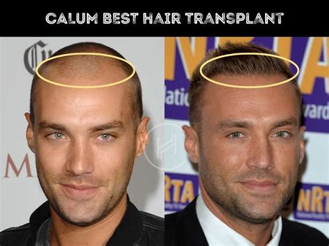 Calum Best Hair Transplant Hair Loss And Technical Analysis