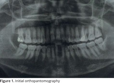 Figure 1 From Treatment Of Maxillary Molar With Furcation Involvement