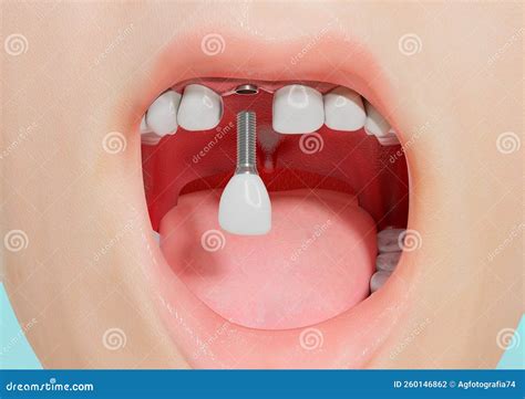 Human Incisor Tooth Implant Dental Crown With Stock Illustration
