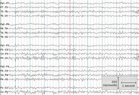 Electroencephalogram Cpt Code
