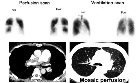 Ventilation Perfusion Scan And Ct Angiograms In Cteph Download