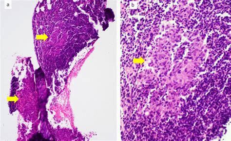 Histopathological Findings Of The Biopsied Bone Marrow The Bone