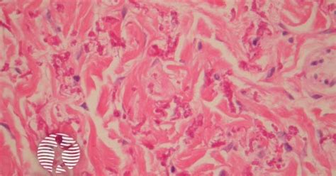 Dermnet® Pseudoxanthoma Elasticum Pathology Image