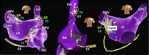 Cardioneuroablation Where Are We At Pmc