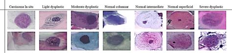 The Cervical Cancer Cell Images Generated By Ccg Taming Transformers