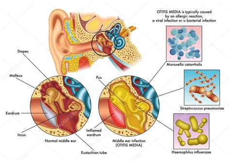 Symptoms Of Otitis Media — Stock Vector © Rob3000 141469484