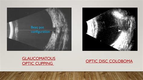 B Scan Procedure Basics In Ophthalmologypptx