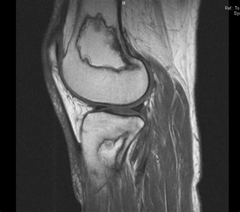 Pain In The Tibia And Multiple Bone Lesions Pain In The Tibia And Multiple Bone Lesions