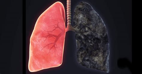 Enfisema Pulmonar O Que é Sintomas Causas e Tratamento MundoBoaForma