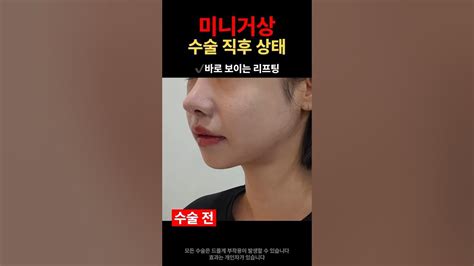 미니거상 미니거상 수술 직후 상태 바로 보이는 리프팅 팔자주름 개선 모즈클리닉 Modsclinic Youtube