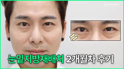인천성형외과｜남자성형｜ 눈밑지방재배치 2개월차 후기｜이렇게 깔끔해진다고 Youtube