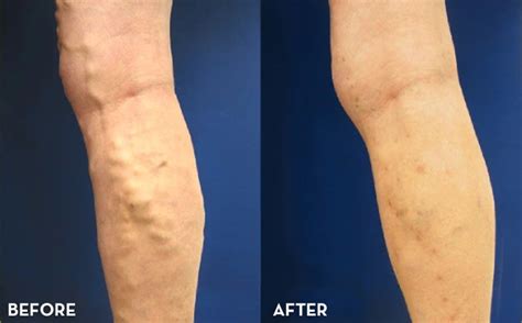 Phlebectomy Denver Bulging Veins La Fontaine