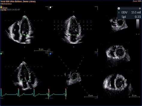 Lv Systolic Function Pptx