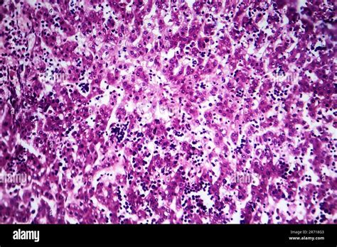Histopathology Of Chronic Active Hepatitis Light Micrograph Photo