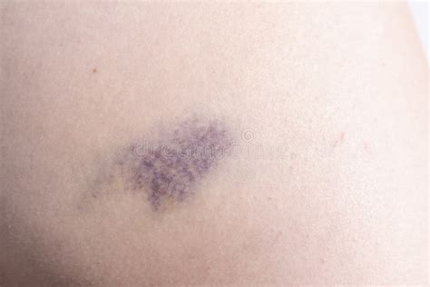 Bruise With Purple Spots In It At Hamish Geake Blog