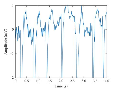 Atrial Fibrillation Beat Identification Using The Combination Of Modified Frequency Slice